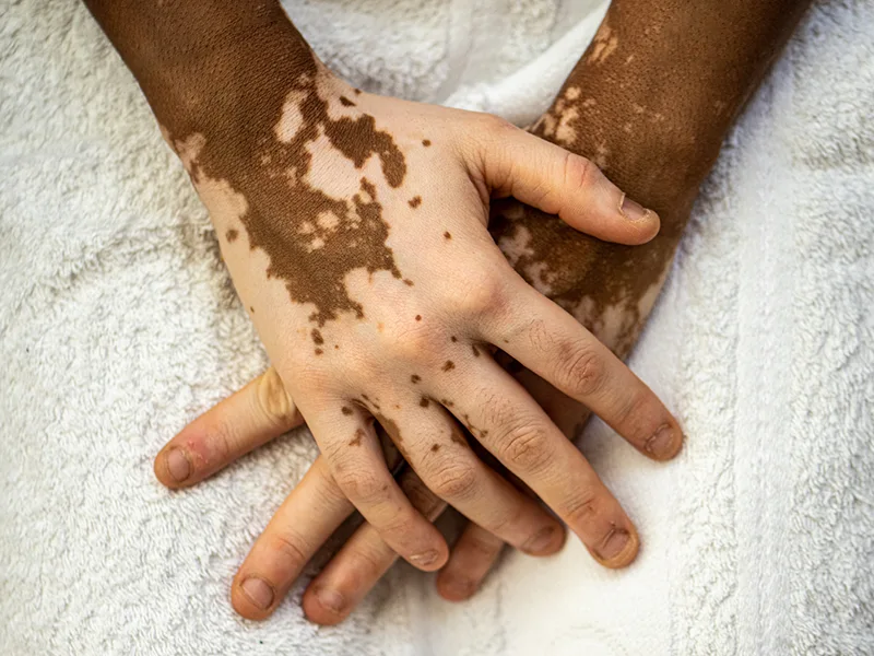 Hypopigmentation Treatments Leicester | Restore Skin Tone & Confidence